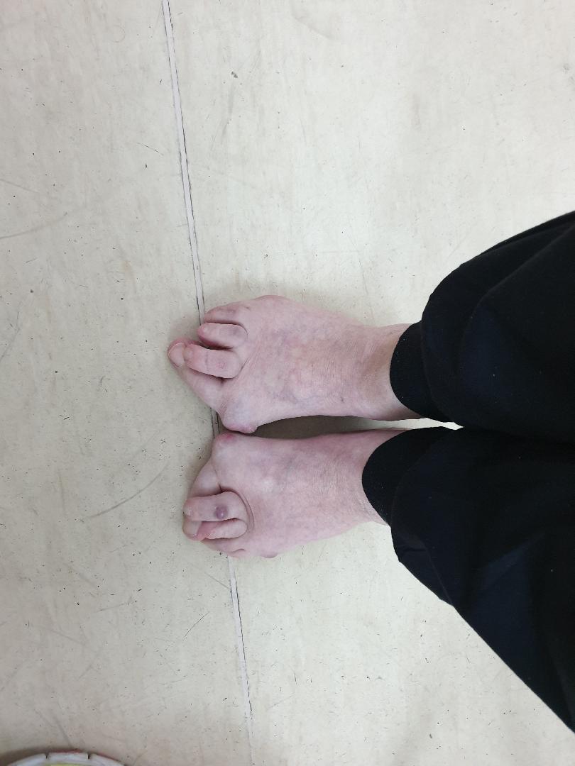 ČUKLJEVI (HALLUX VALGUS) NAJČEŠĆI DEFORMITET STOPALA – ORTOPEDSKA ...