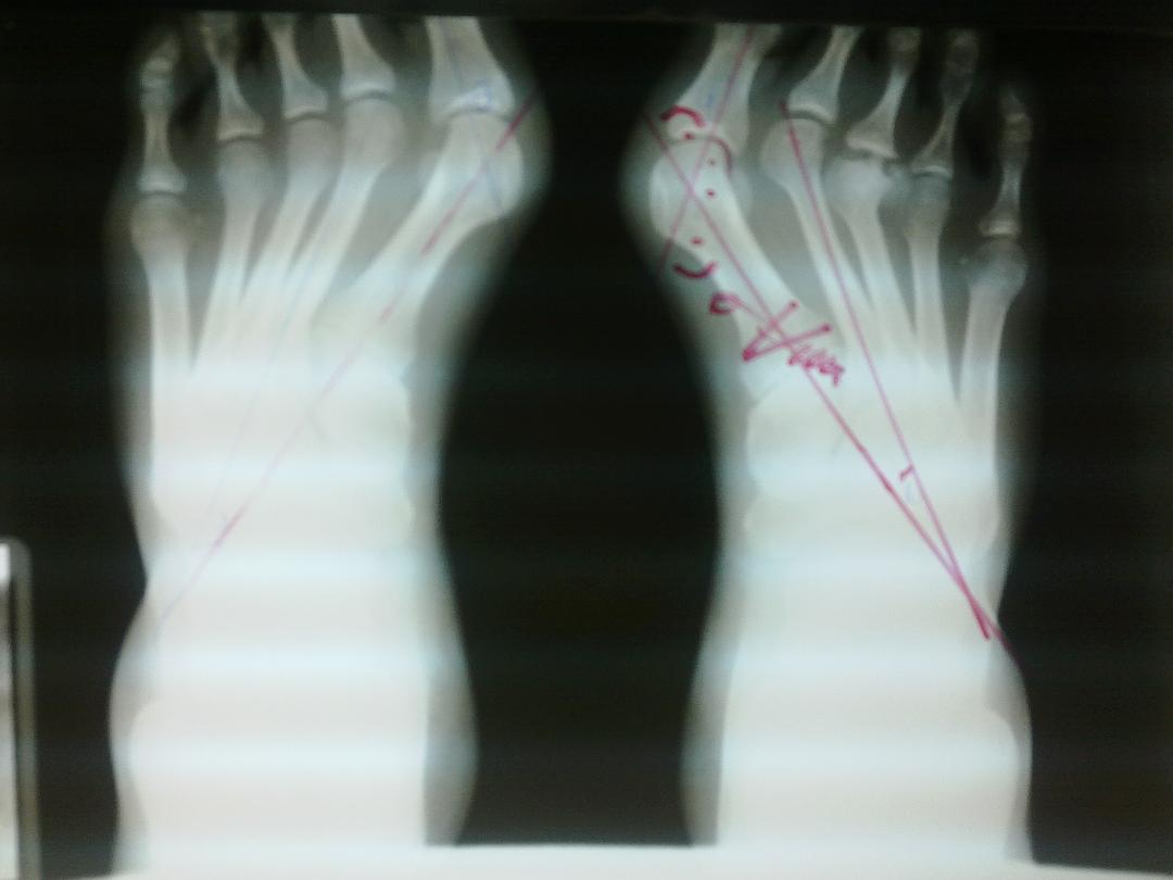 ČUKLJEVI (HALLUX VALGUS) NAJČEŠĆI DEFORMITET STOPALA – ORTOPEDSKA ...